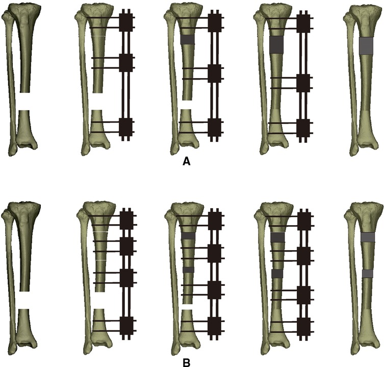 Frontiers | Bone Defects in Tibia Managed by the Bifocal vs. Trifocal ...