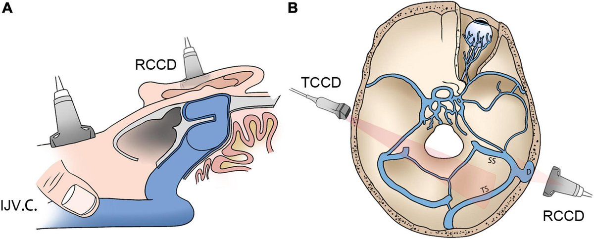 Frontiers | Retroauricular/Transcranial Color-Coded Doppler Ultrasound ...