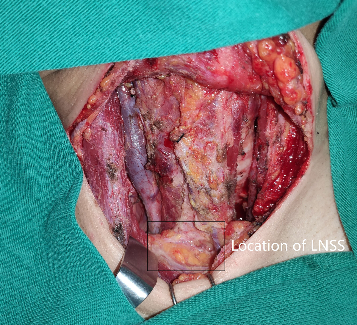 Frontiers | The Necessity of Lymph Node Dissection Between ...