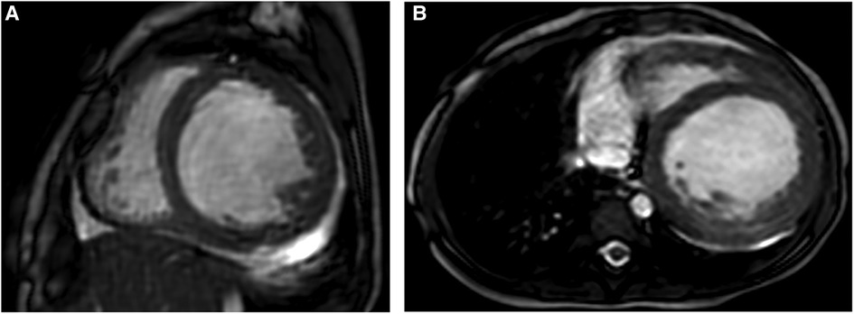 Frontiers | The value of cardiac magnetic resonance imaging in ...