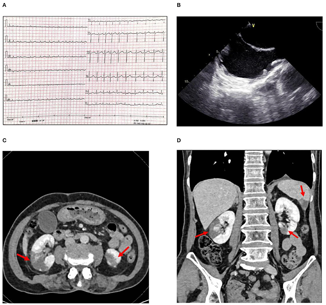 Frontiers | Case Report: Acute Renal and Splenic Infarctions Secondary ...