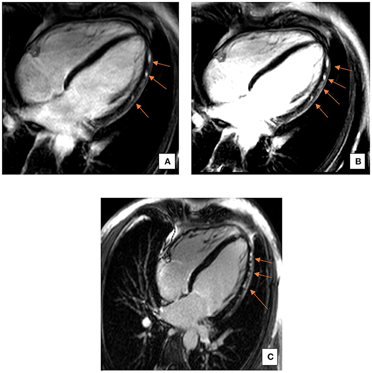 Frontiers | Case Report: Transient Increase of CMR T1 Mapping Indices ...