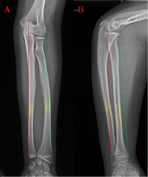 Frontiers | Radial and ulnar medullary canal diameter in children ...