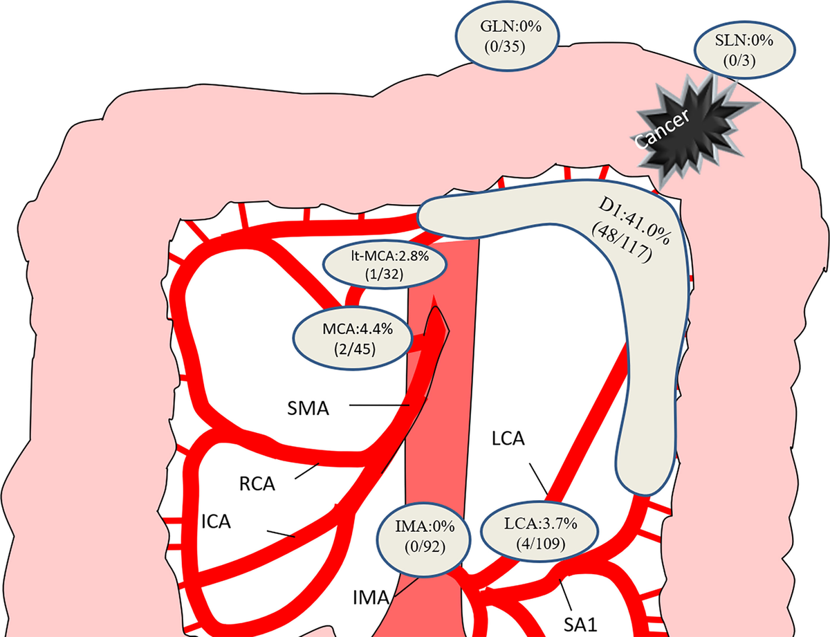 Frontiers | Surgical Treatment of SplenicFlexure Colon Cancer ...