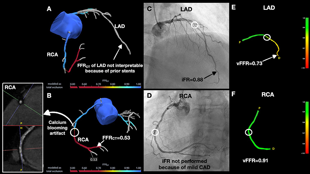 Frontiers | Case Report: Invasive and Non-invasive Hemodynamic ...