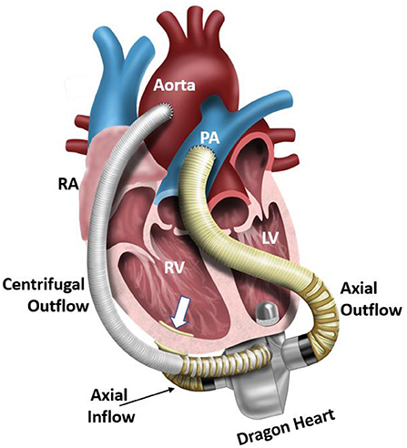 Frontiers | Development of the Centrifugal Blood Pump for a Hybrid ...