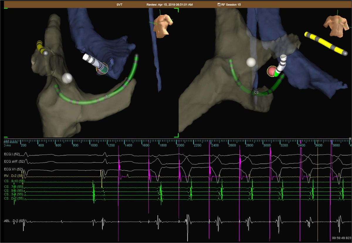 Frontiers | Transseptal Approach Versus Transaortic Approach for ...