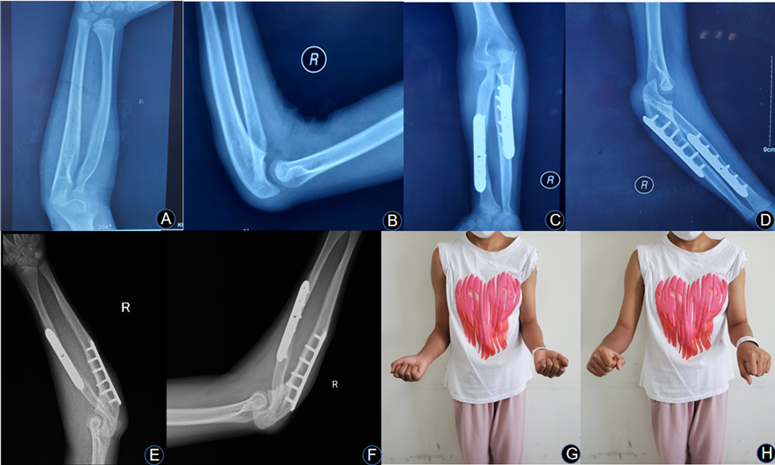 Frontiers | Derotational Osteotomy and Plate Fixation of the Radius and ...
