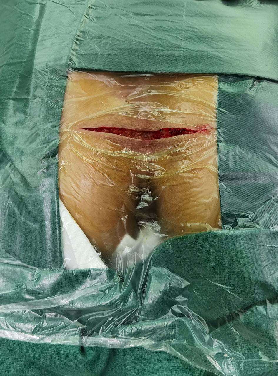 Frontiers | Is There Another Posterior Approach for Presacral Tumors ...