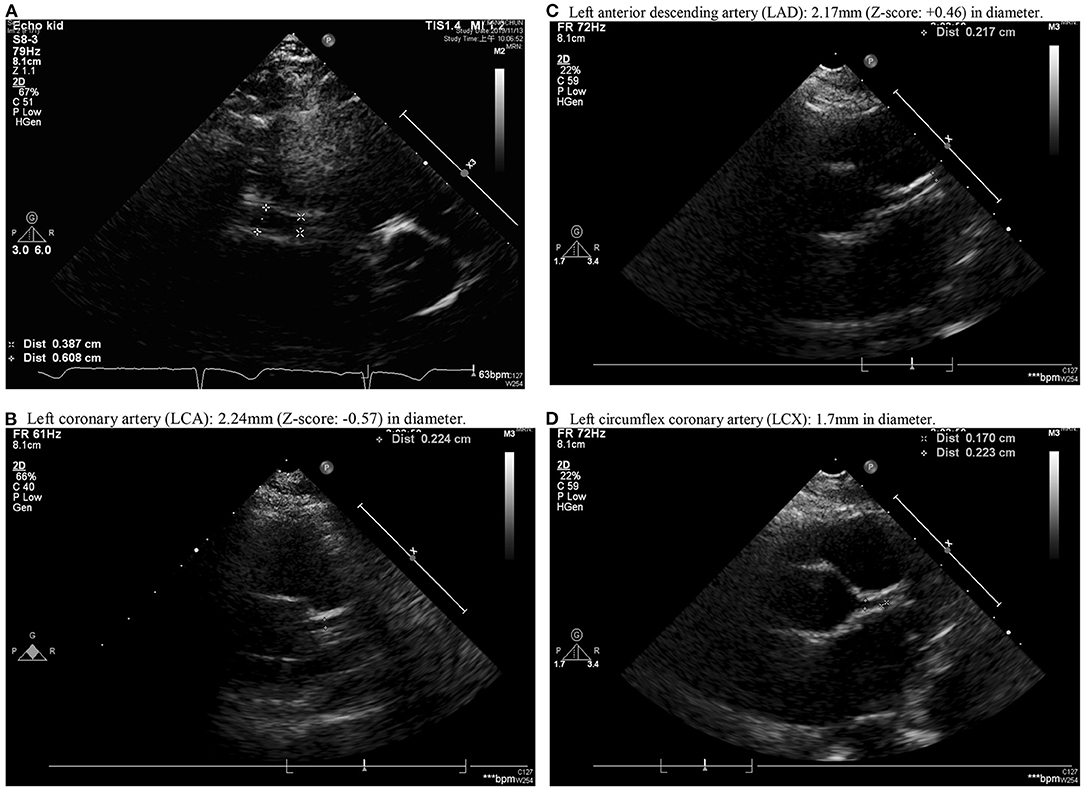 Frontiers | Hydrogen Gas Inhalation Regressed Coronary Artery Aneurysm ...