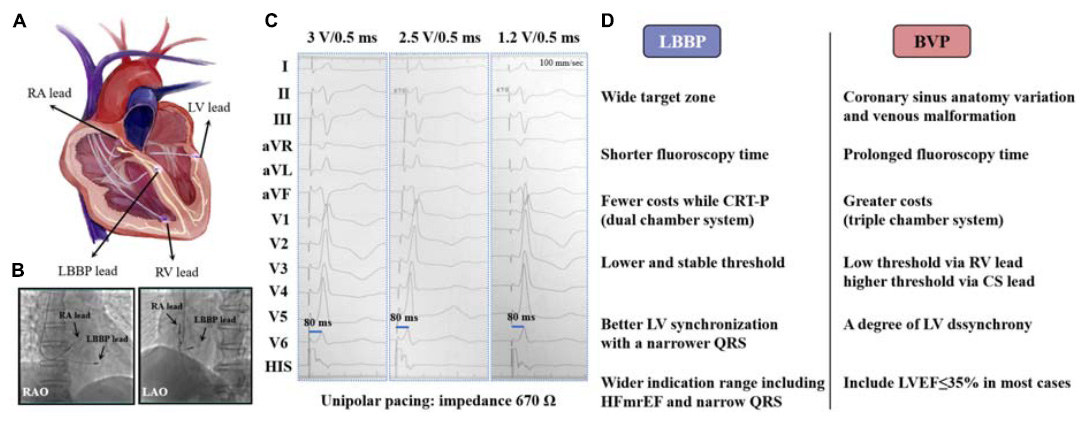 Frontiers | Left bundle branch area pacing: A promising modality for ...