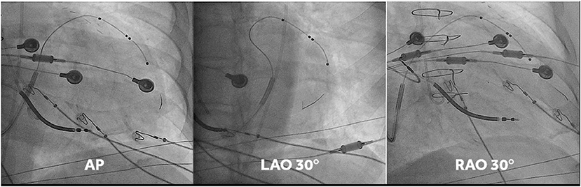 Frontiers | Acute Hemodynamic Effects of Simultaneous and Sequential ...