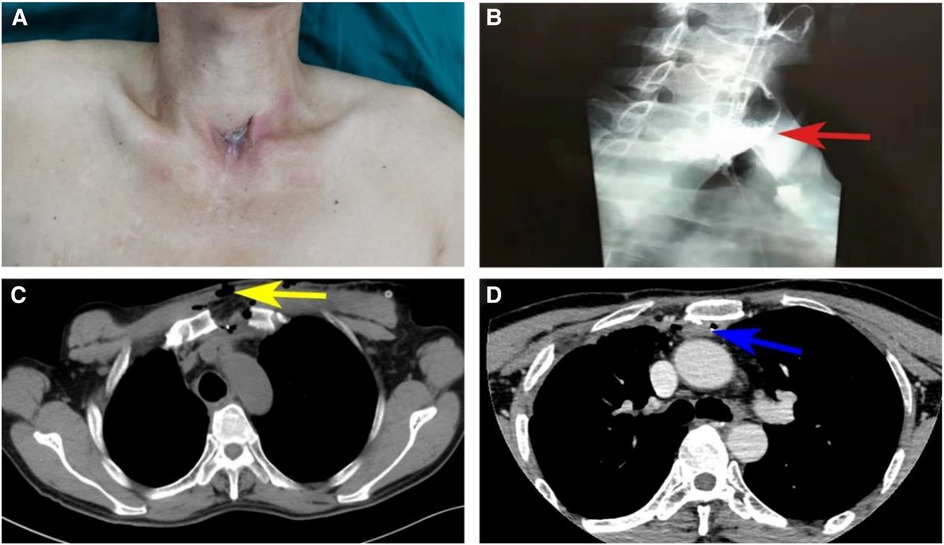 Frontiers | Successful cervicothoracic esophageal stricture treatment ...