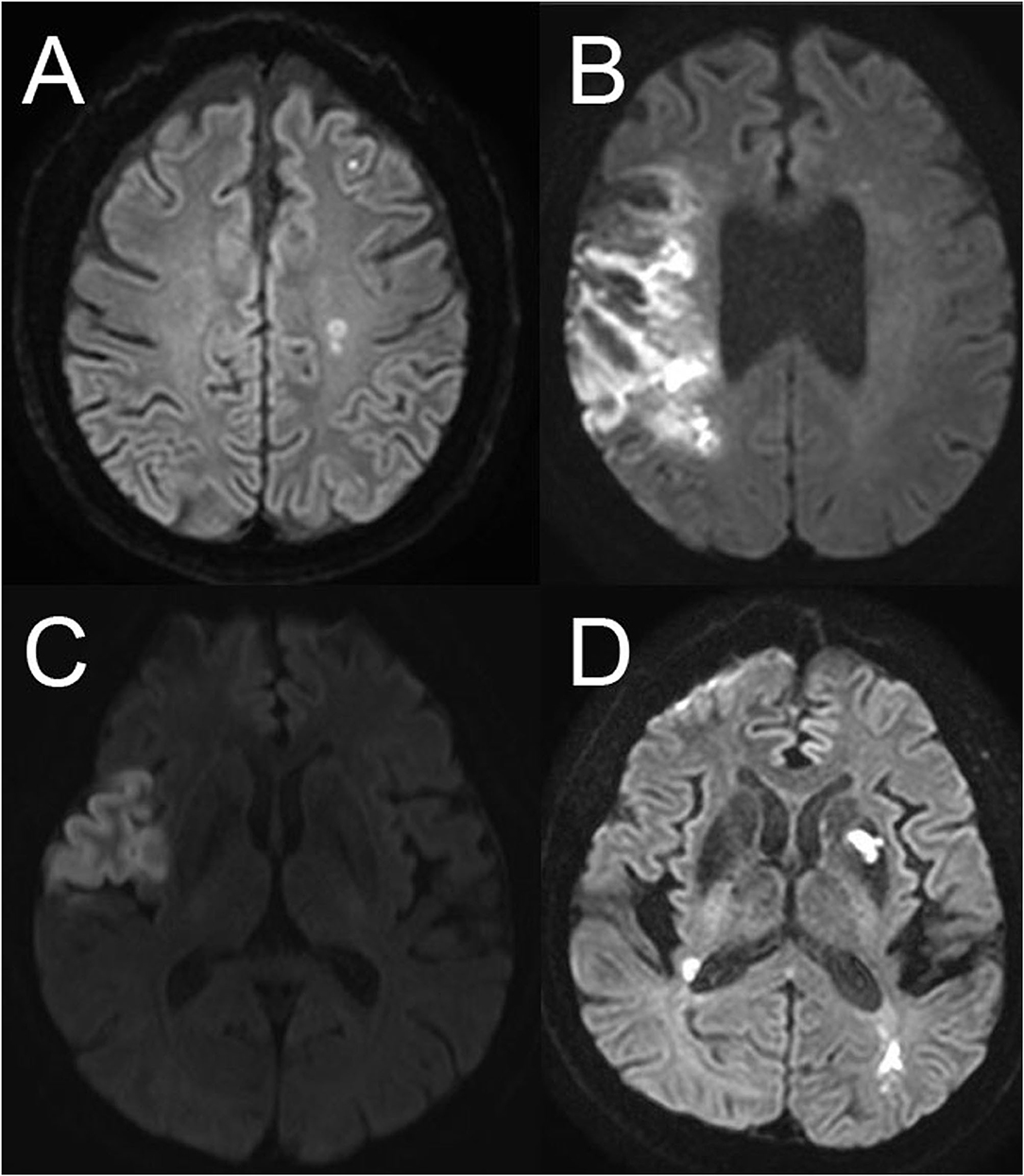 Frontiers | Impact of Neuroimaging Patterns for the Detection of Atrial ...