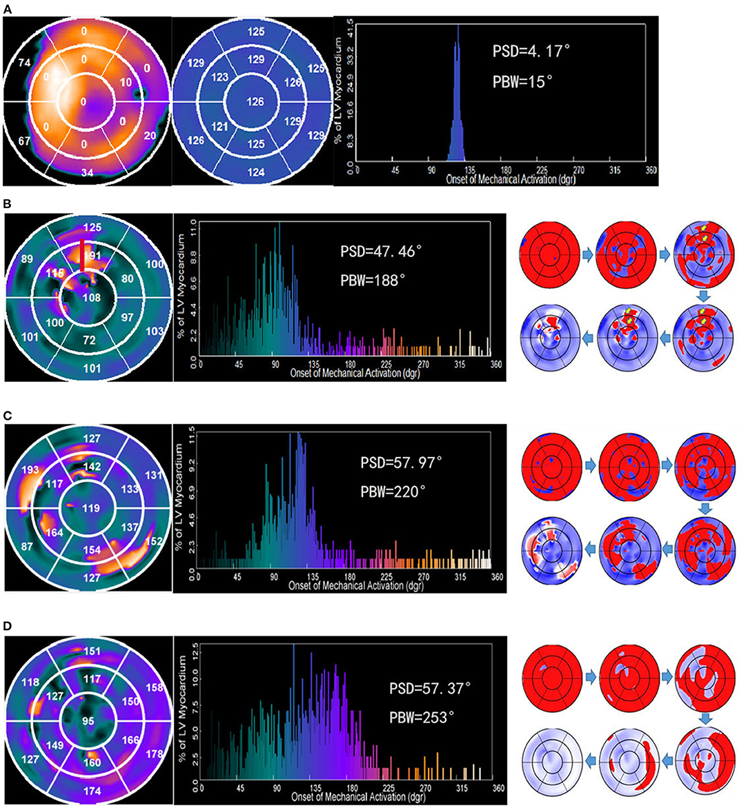 Frontiers | A Mild Dyssynchronous Contraction Pattern Detected by SPECT ...