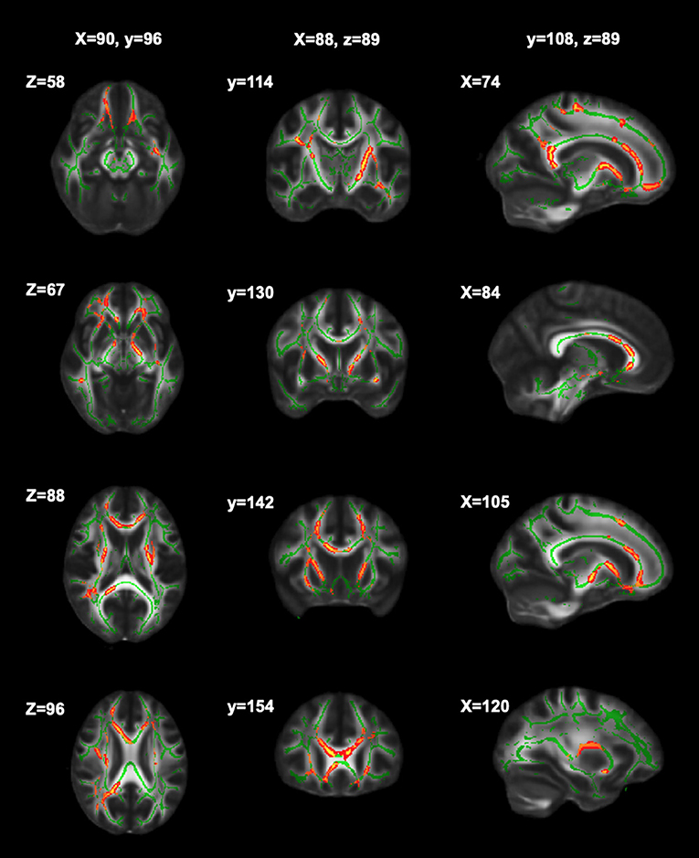 Frontiers Associations Of White Matter And Basal Ganglia