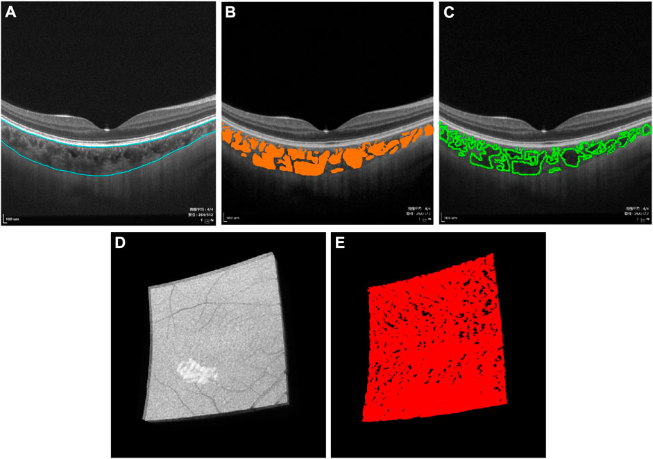 Frontiers | Compartmental analysis of three-dimensional choroidal ...