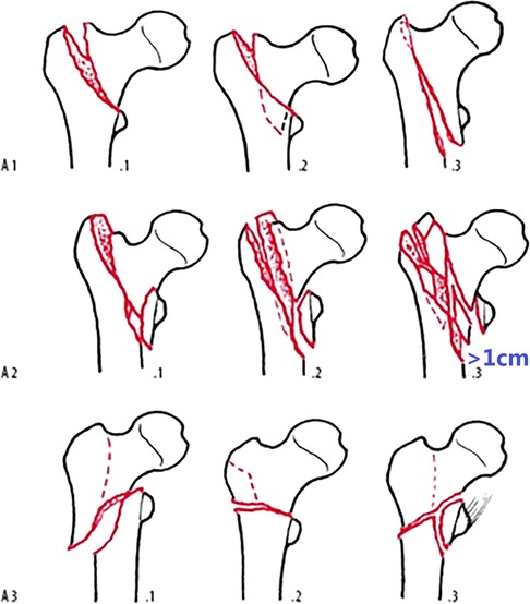 Frontiers | A sophisticated fracture classification system of the ...