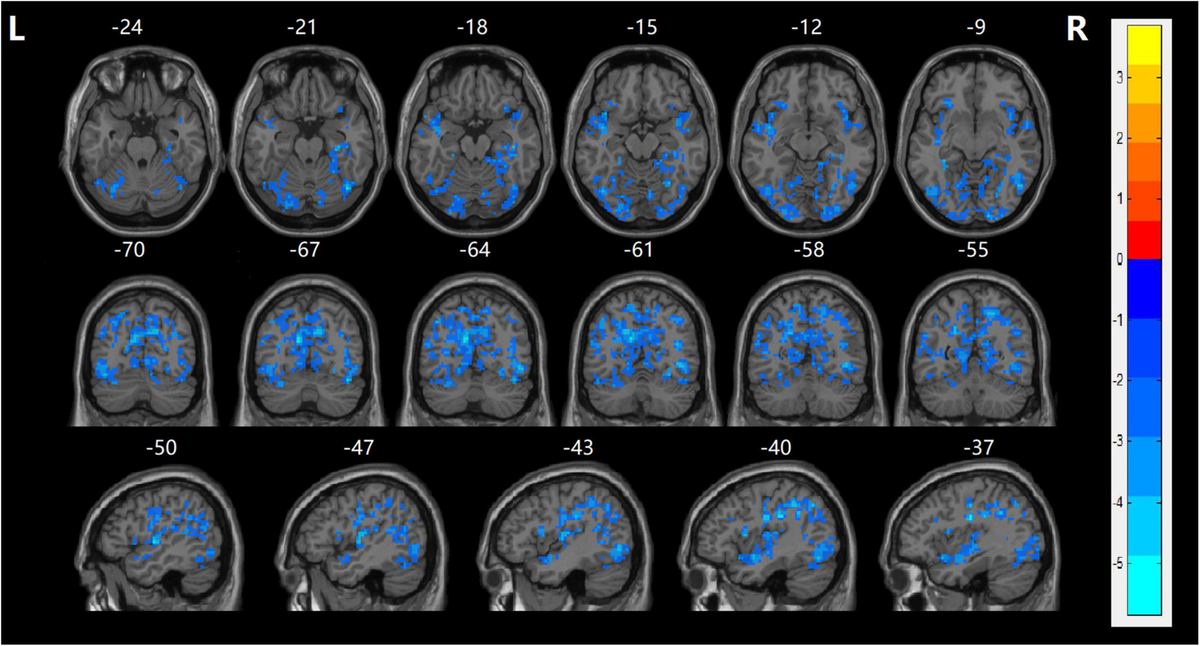 Frontiers | Aberrant Functional Connectivity of the Orbitofrontal ...