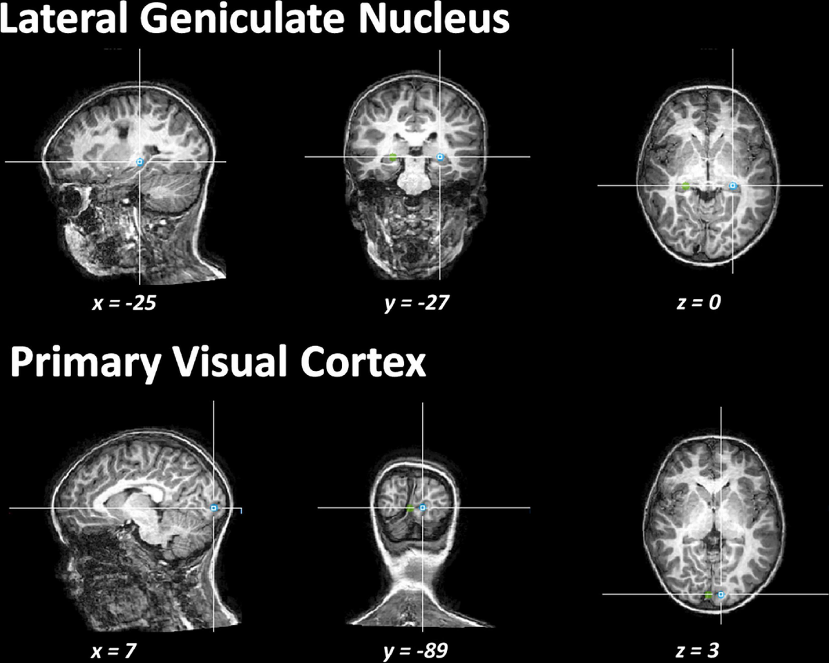 Frontiers | Impact of early brain lesions on the optic radiations in ...