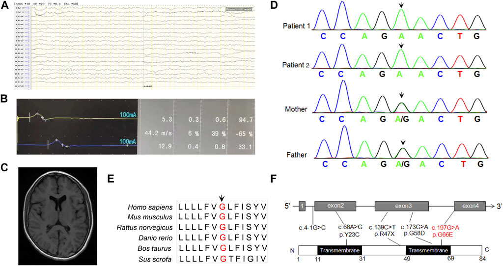 Frontiers | Identification and characterization of a new variation in ...