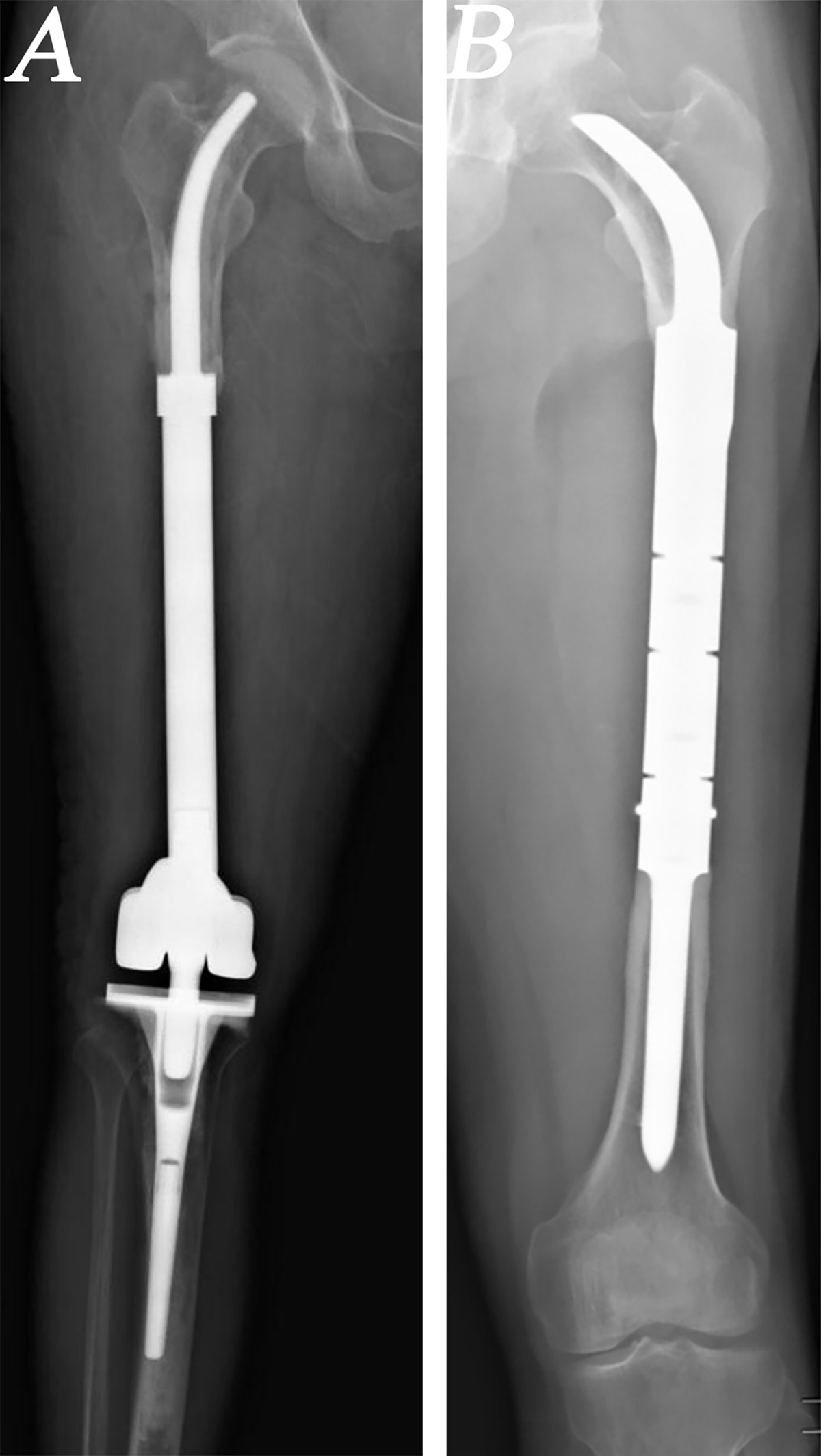 Frontiers | A comparison of cemented and cementless intra-neck curved ...