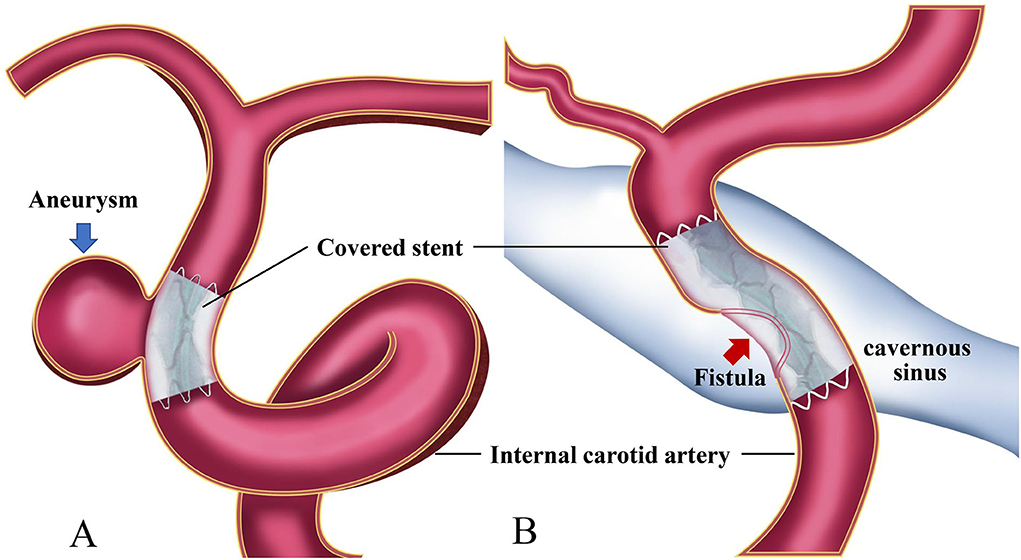 Frontiers | Use of covered stents to treat complex cerebrovascular ...