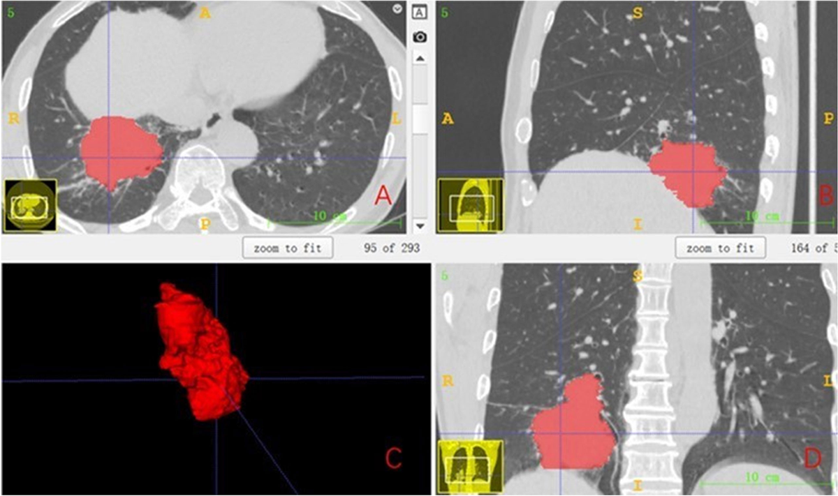 Frontiers | CT-based radiomics in predicting pathological response in ...