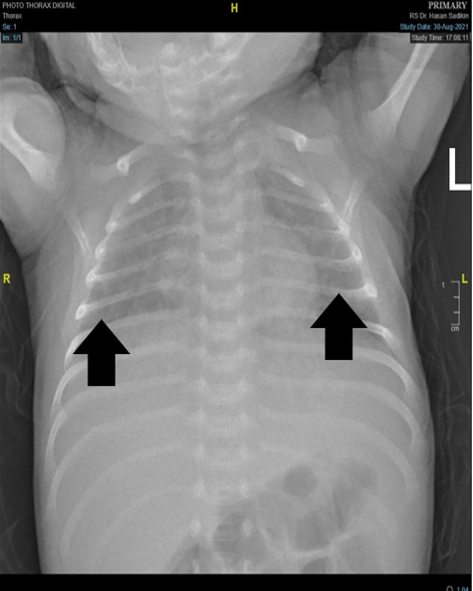 Congenital Tuberculosis In A Neonate A Case Report And Literature ...