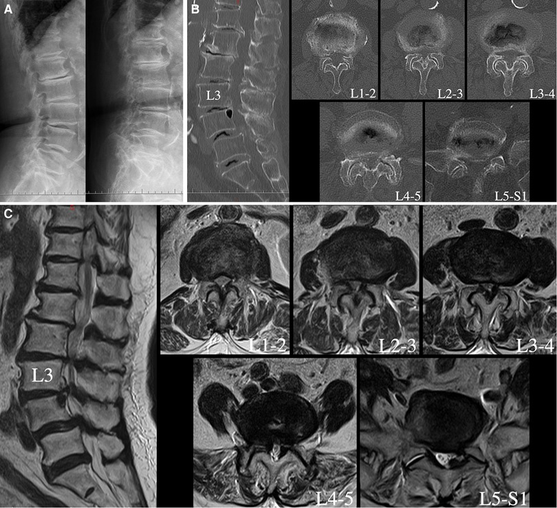 Frontiers | Case Report: Five-Level Unilateral Laminectomy Bilateral ...