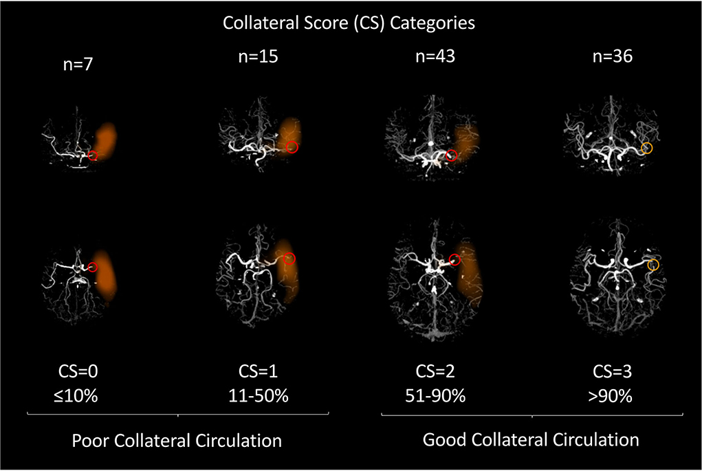 Frontiers | Automated scoring of collaterals, blood pressure, and ...