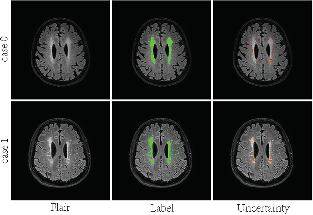 Frontiers | Ensemble learning via supervision augmentation for white matter hyperintensity ...