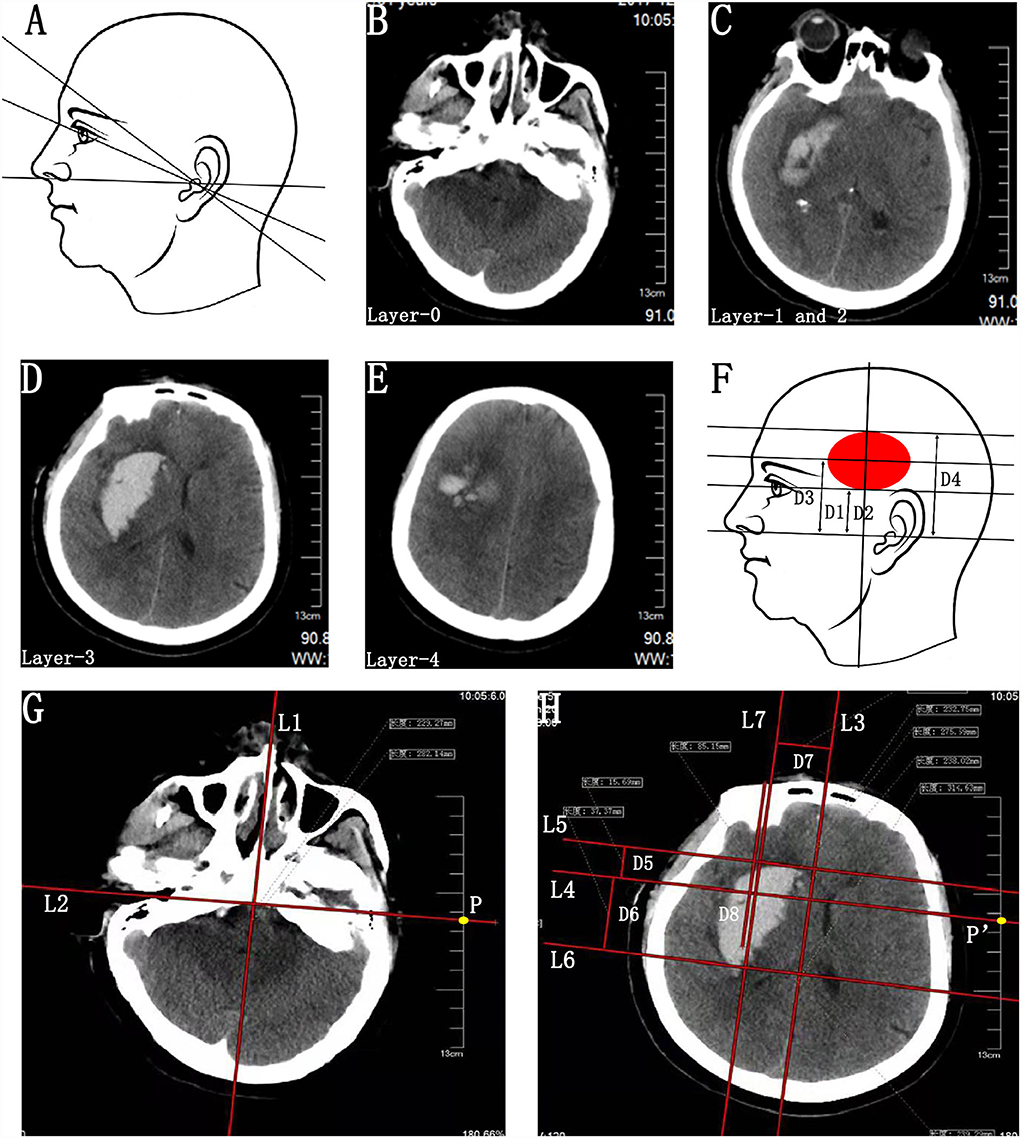 Frontiers | Individualized CT image-guided free-hand catheter technique ...