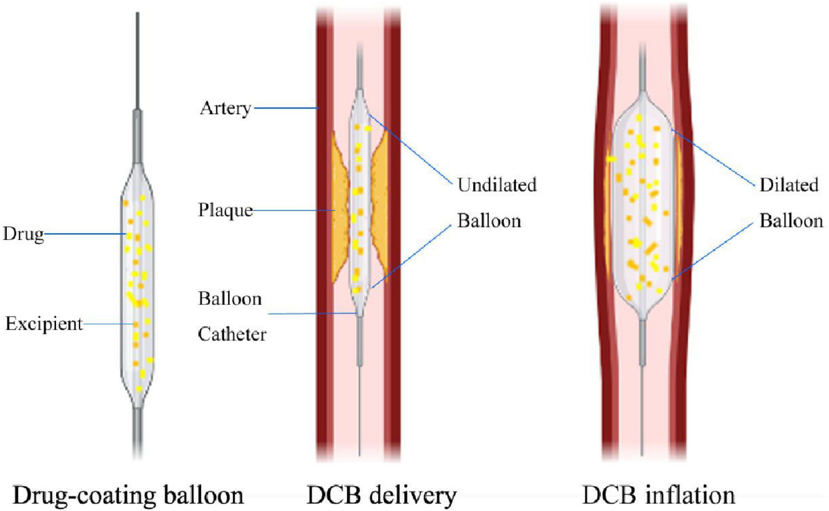 Frontiers | The factors influencing the efficiency of drug-coated balloons