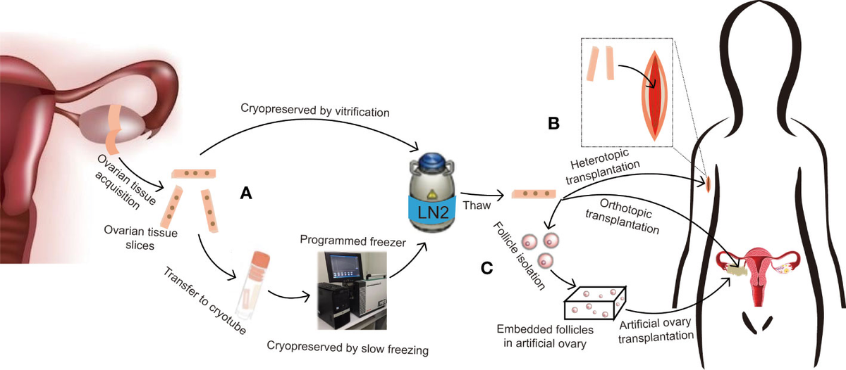Frontiers | Ovarian tissue bank for fertility preservation and anti ...