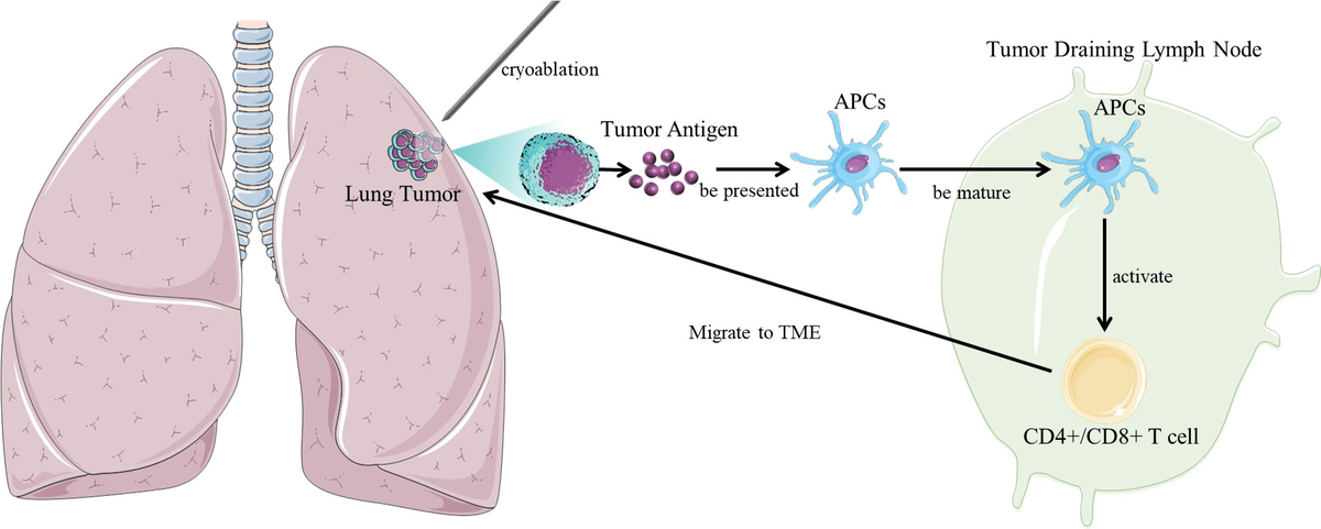 Frontiers | Cryoablation and immune synergistic effect for lung cancer ...
