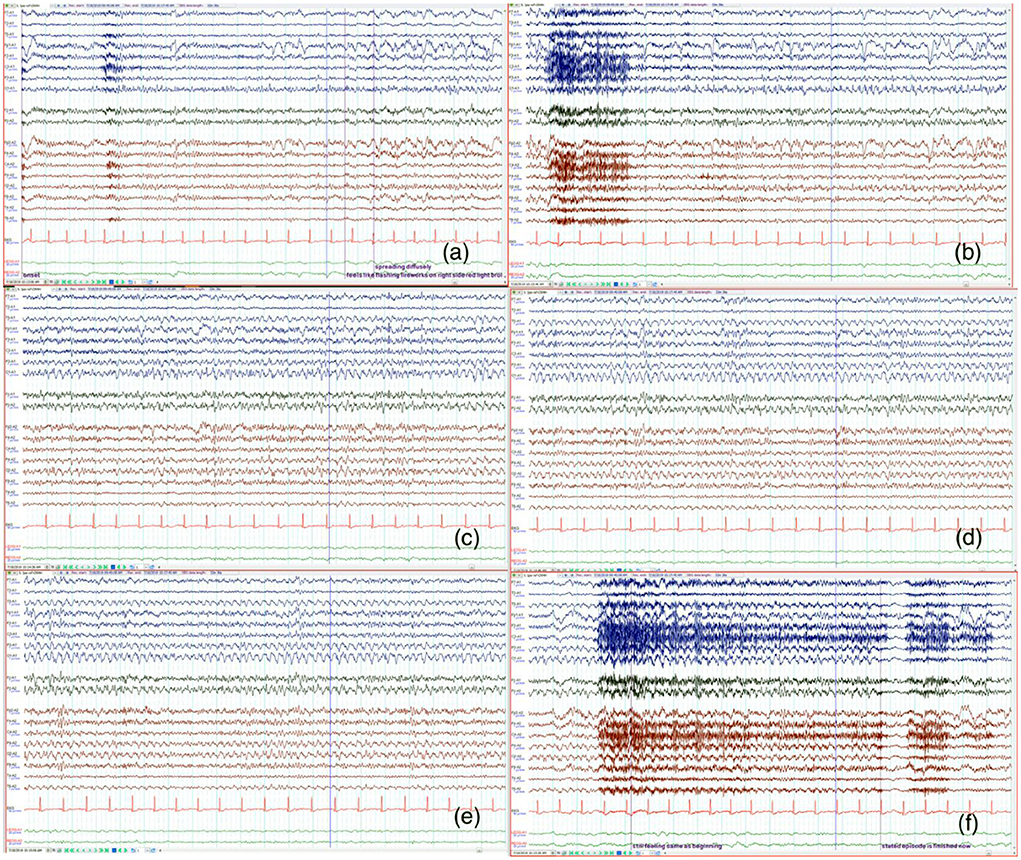 Frontiers | Case report: An EEG captured case of migralepsy/migraine ...