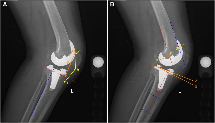 Frontiers | 3D-printed patient-specific instrumentation decreases the ...