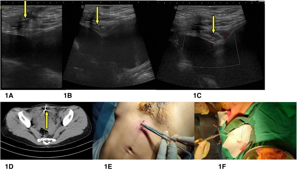 Frontiers | Case report: An intrauterine device hugging the musculus ...