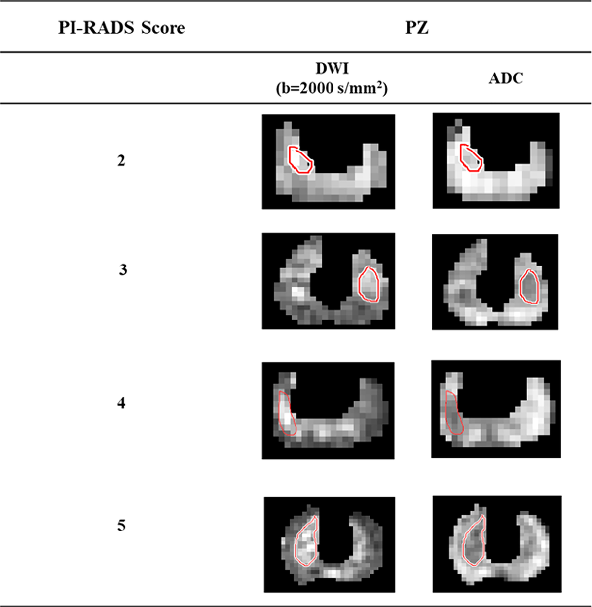 Frontiers | Machine learning-based analysis of a semi-automated PI-RADS ...