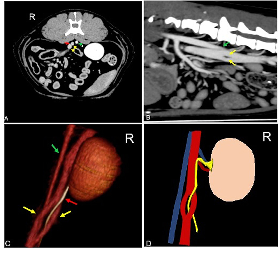 Frontiers | Computed tomographic appearance of transcaval ureter in two ...