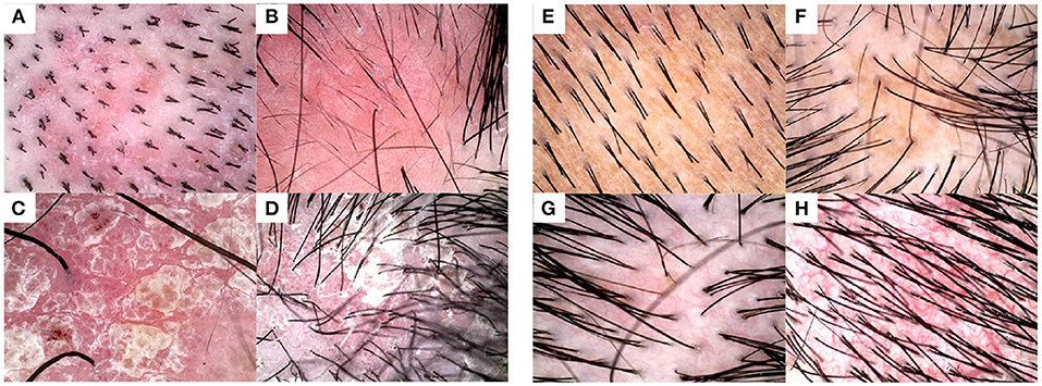 Frontiers | A deep learning-based approach toward differentiating scalp ...