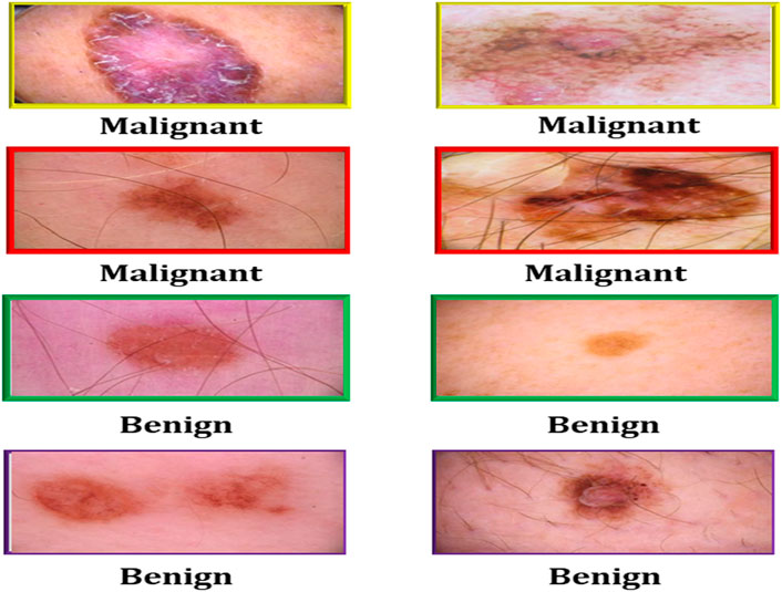 Melanoma Skin Cancer Stages