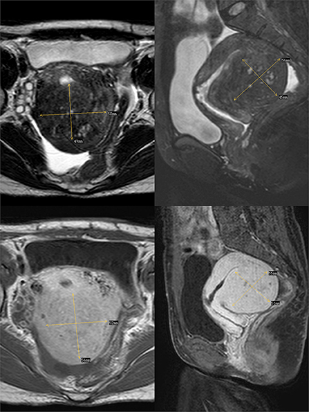 Frontiers | Spontaneous rupture of the uterus in the third trimester ...