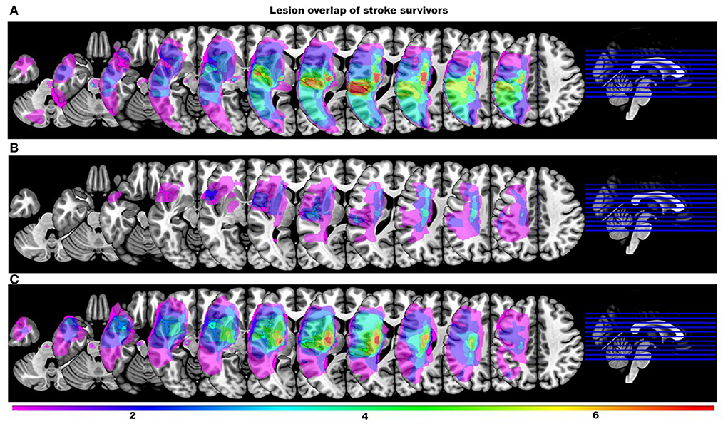 Frontiers | The relationship between motor pathway damage and flexion ...
