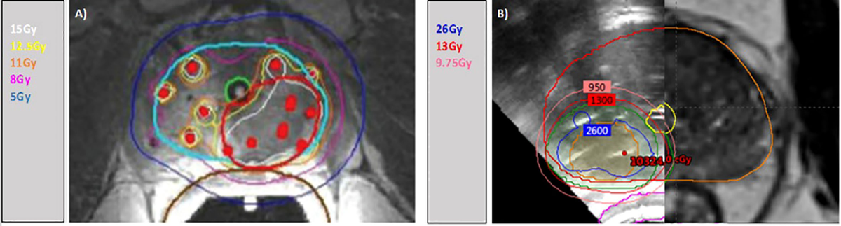 Frontiers | MRI-guided focal or integrated boost high dose rate ...