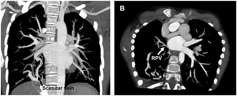 Frontiers | Treatment and prognosis of Scimitar syndrome: A ...