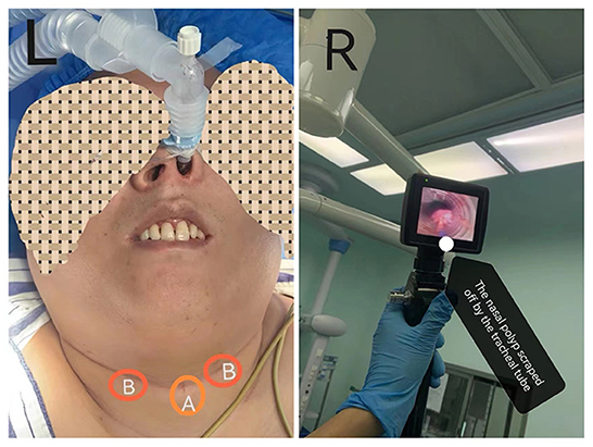 Nasal breathing tube store