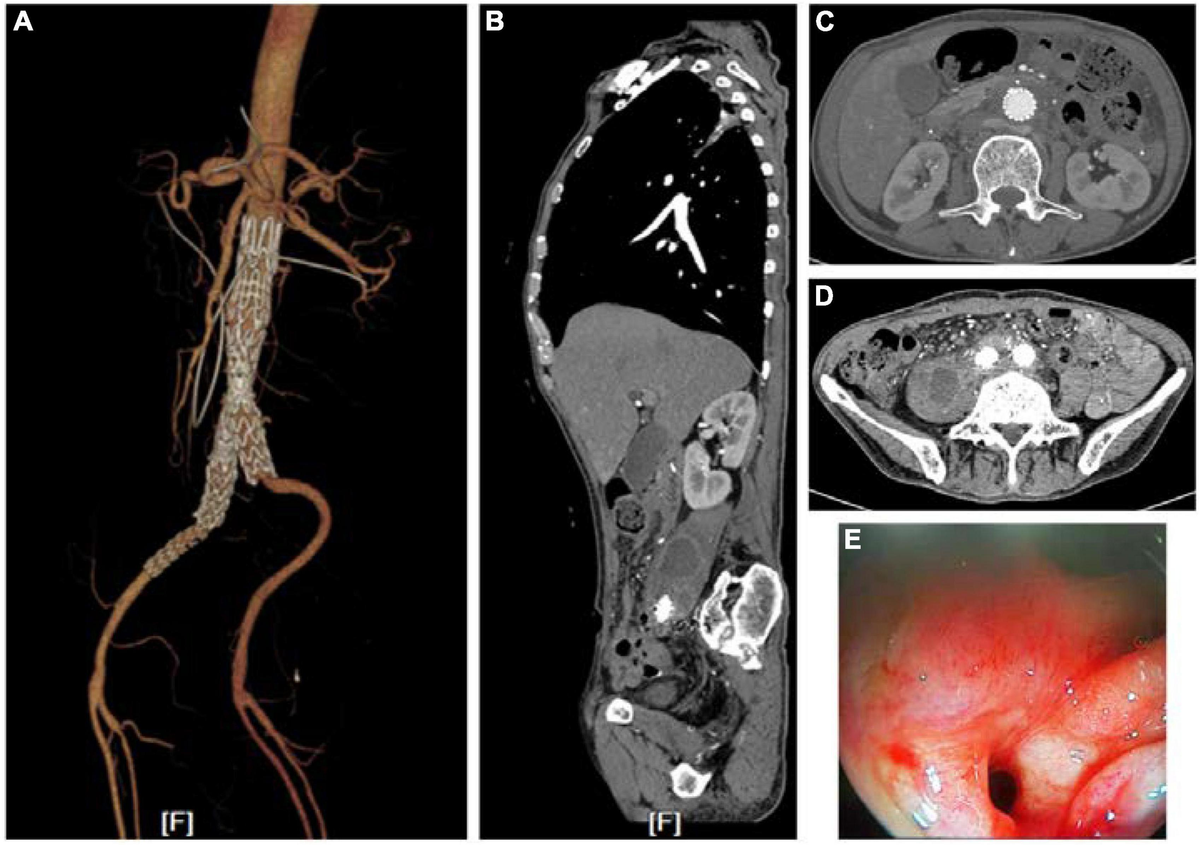 Frontiers | Case report: Remedial surgical treatment of aorto-duodenal ...
