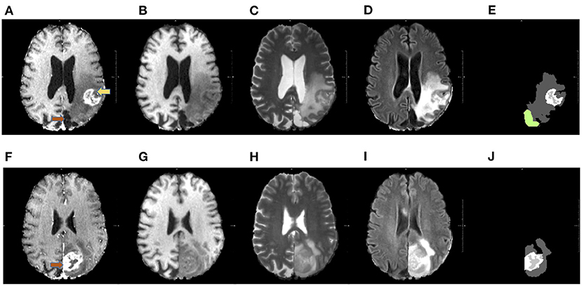 Frontiers | Quantitative evaluation of the influence of multiple MRI ...